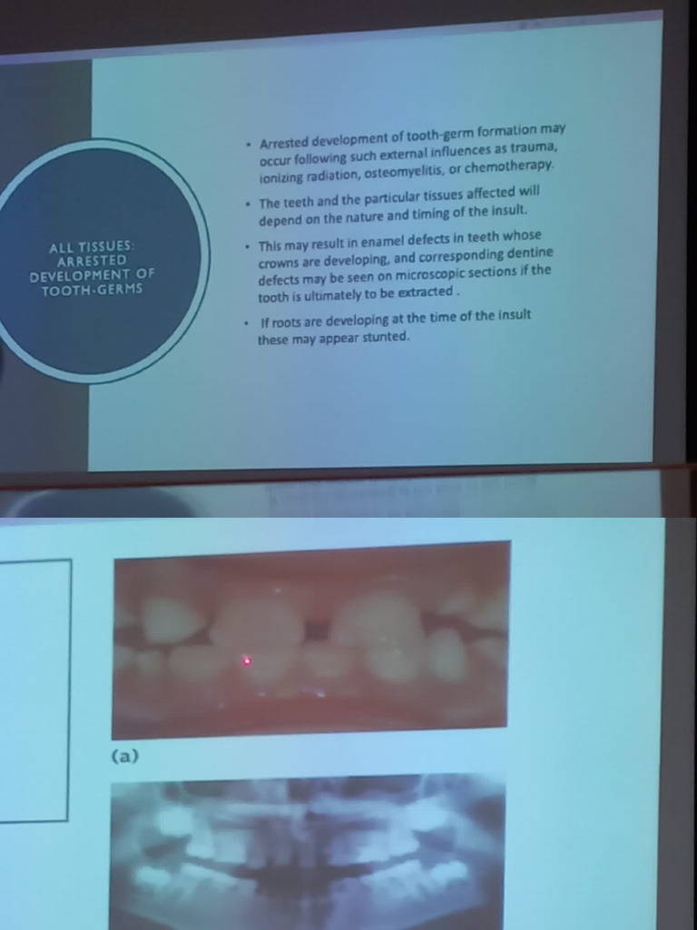 Abnormalities of Teeth Lecture 2 | PDF