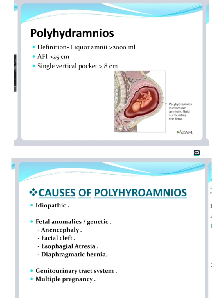 Polyhydramnios | PDF