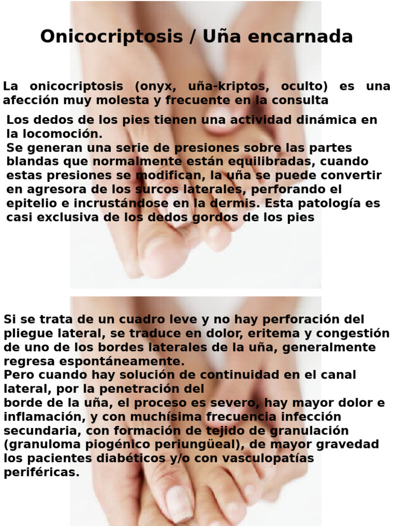 Onicocriptosis | PDF