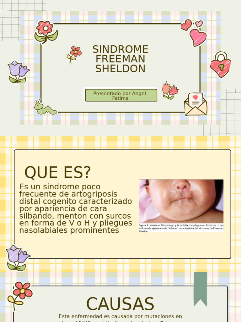 Sindrome Freeman Sheldon | PDF