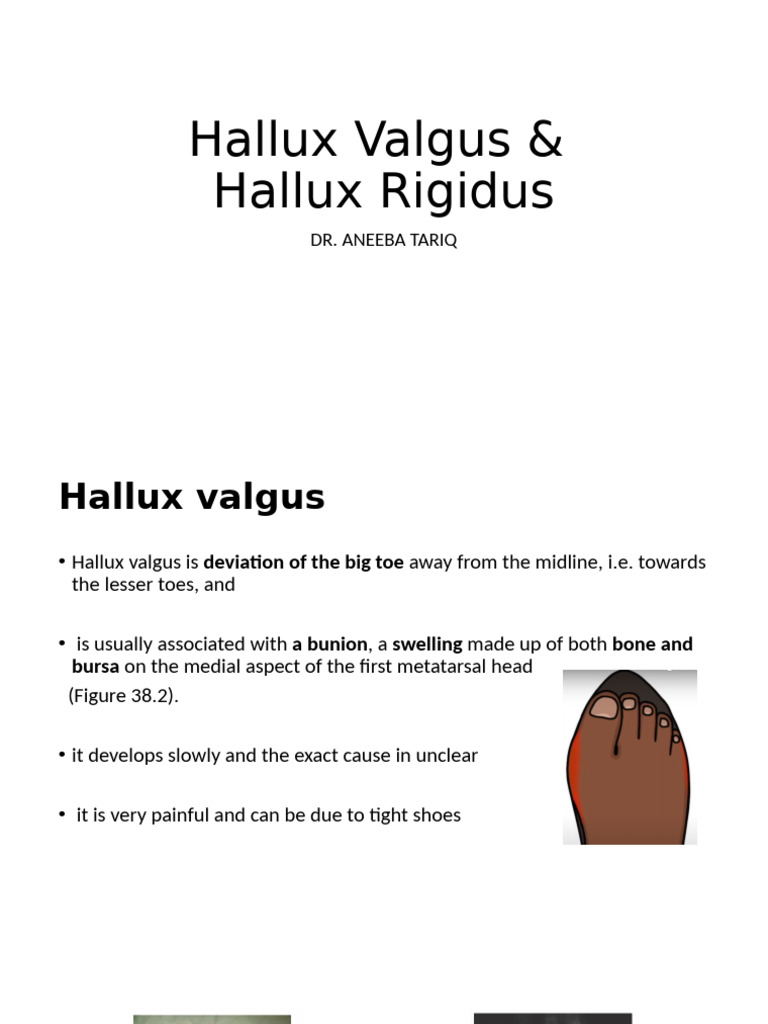 Hallux Valgus | PDF