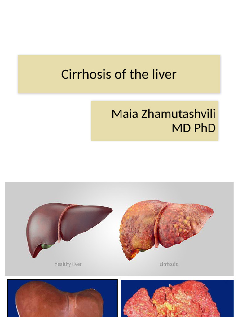 1 GB Bat Cirrhosis of The Liver S | PDF | Cirrhosis | Liver