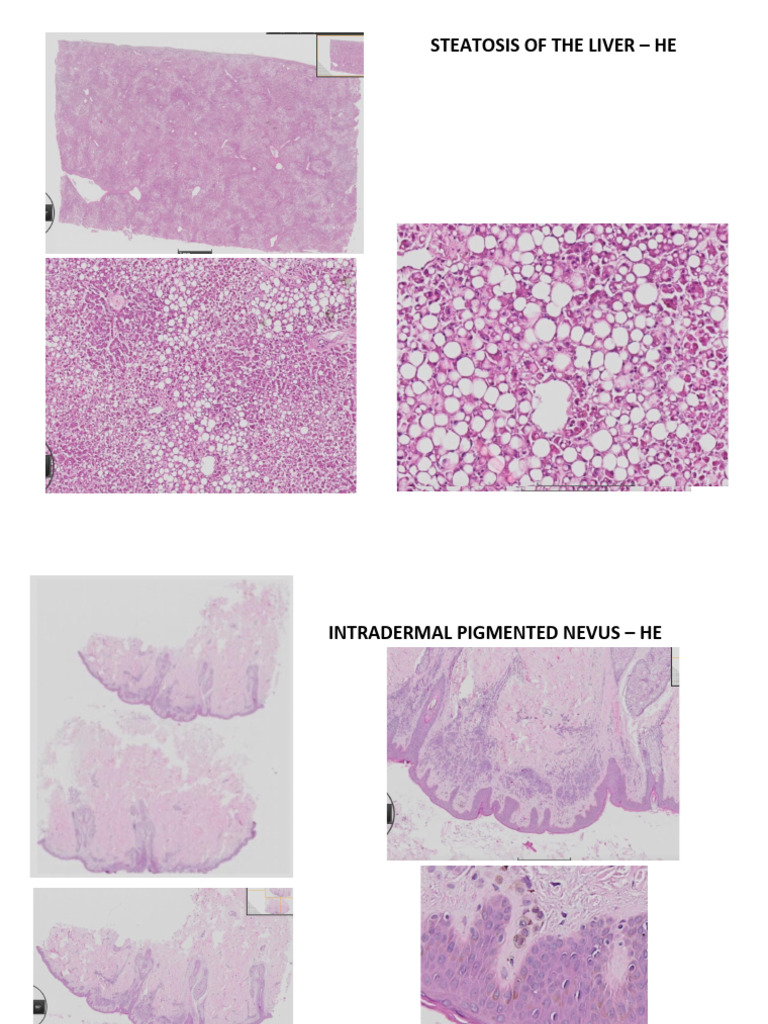 Olympus Screenshots of Pathoanatomy | PDF | Carcinoma | Kidney