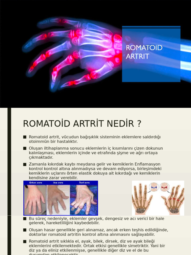 Romatoid Artrit 2 | PDF