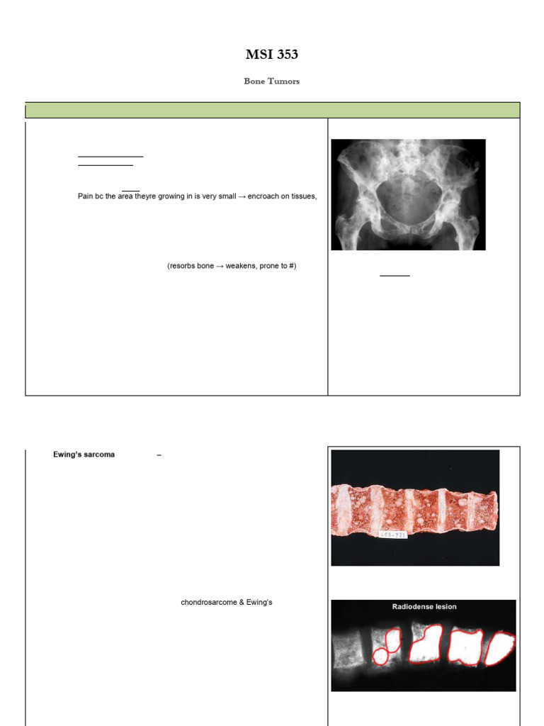 MSI Bones Tumors | PDF | Bone | Benign Tumor