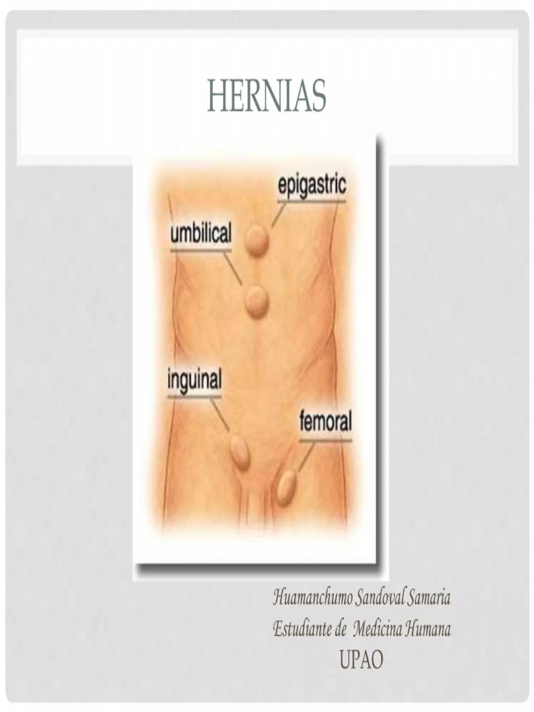 Hernias | PDF