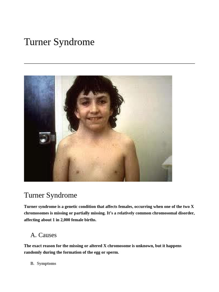 Turner Syndrome Science | PDF