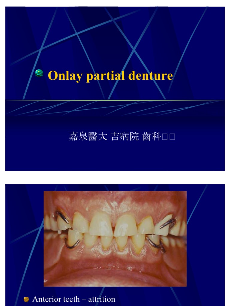 Onlay Partial Denture | PDF | Mouth | Dentistry