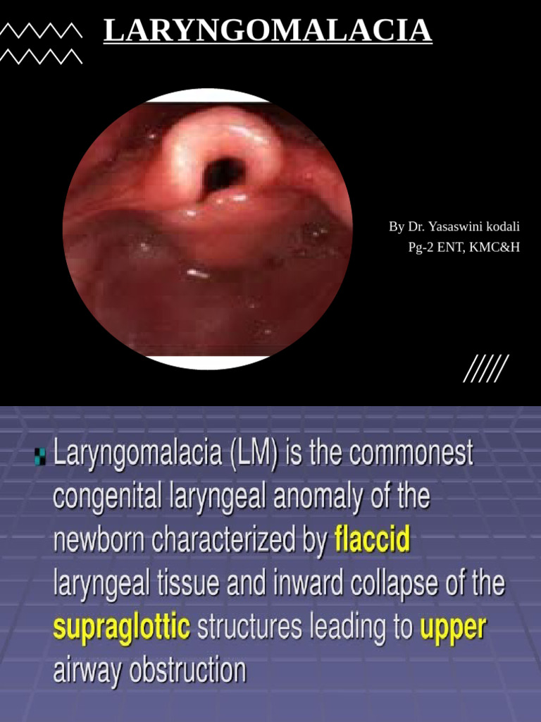 Laryngomalacia 3 | PDF
