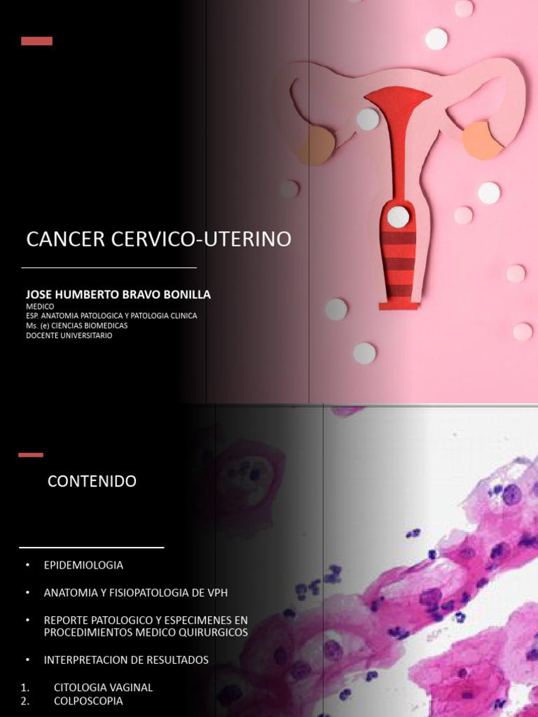 Cancer Cervicouterino 2020 | PDF | Cáncer | Carcinogénesis