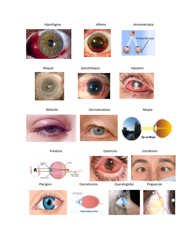 oftalmo Hifema Anisometropia | PDF