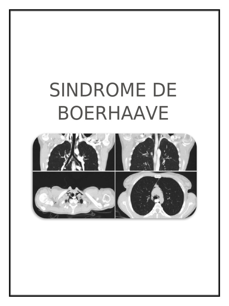 SINDROME DE BOERHAAVE | PDF | Tórax | Medicina CLINICA