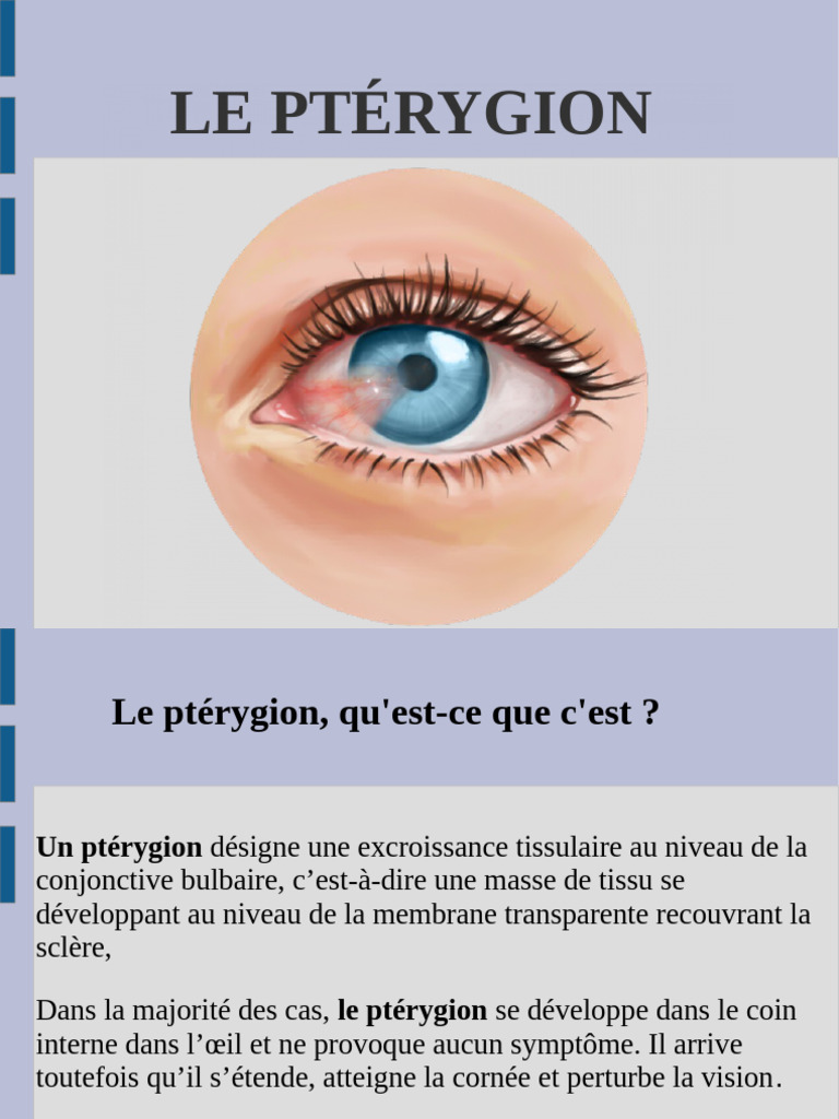 Pterygion | PDF | Ophtalmologie | Cornée