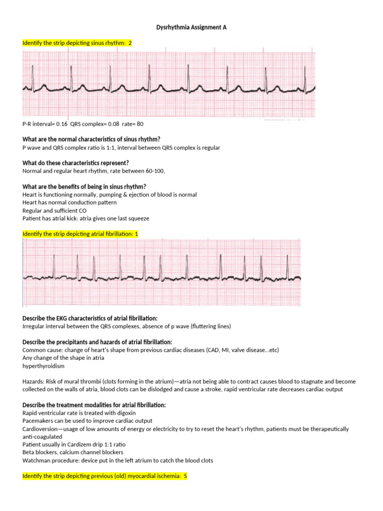Dysrhythmia Types | PDF | Heart | Atrium (Heart)