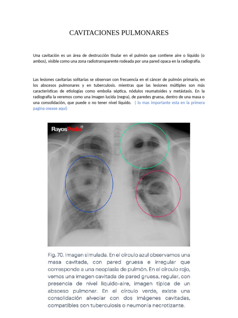 Cavitaciones Pulmonares | PDF | Cáncer de pulmón | Enfermedades y ...