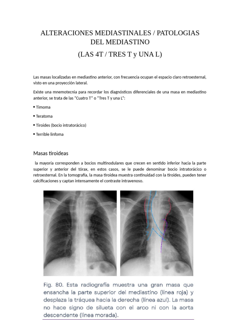 Alteraciones Mediastinales | PDF