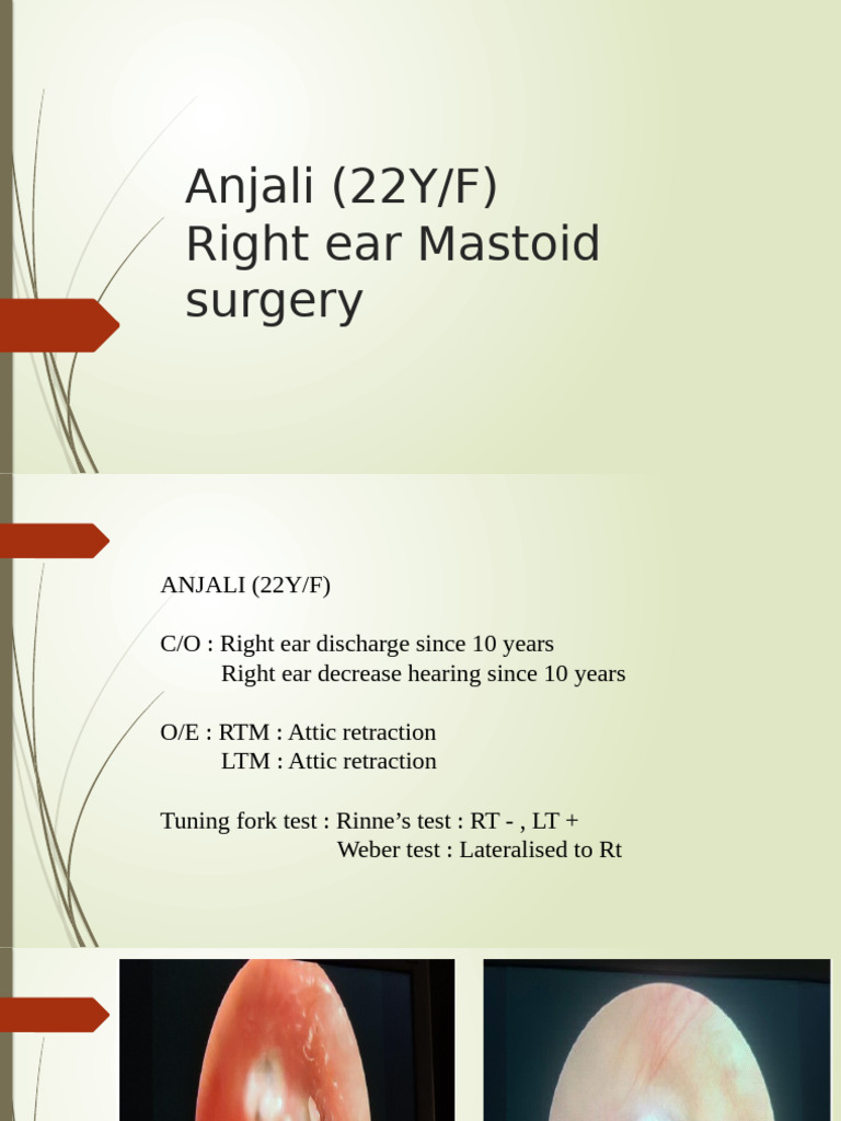 Right Ear Mastoid Surgery Case Study | PDF