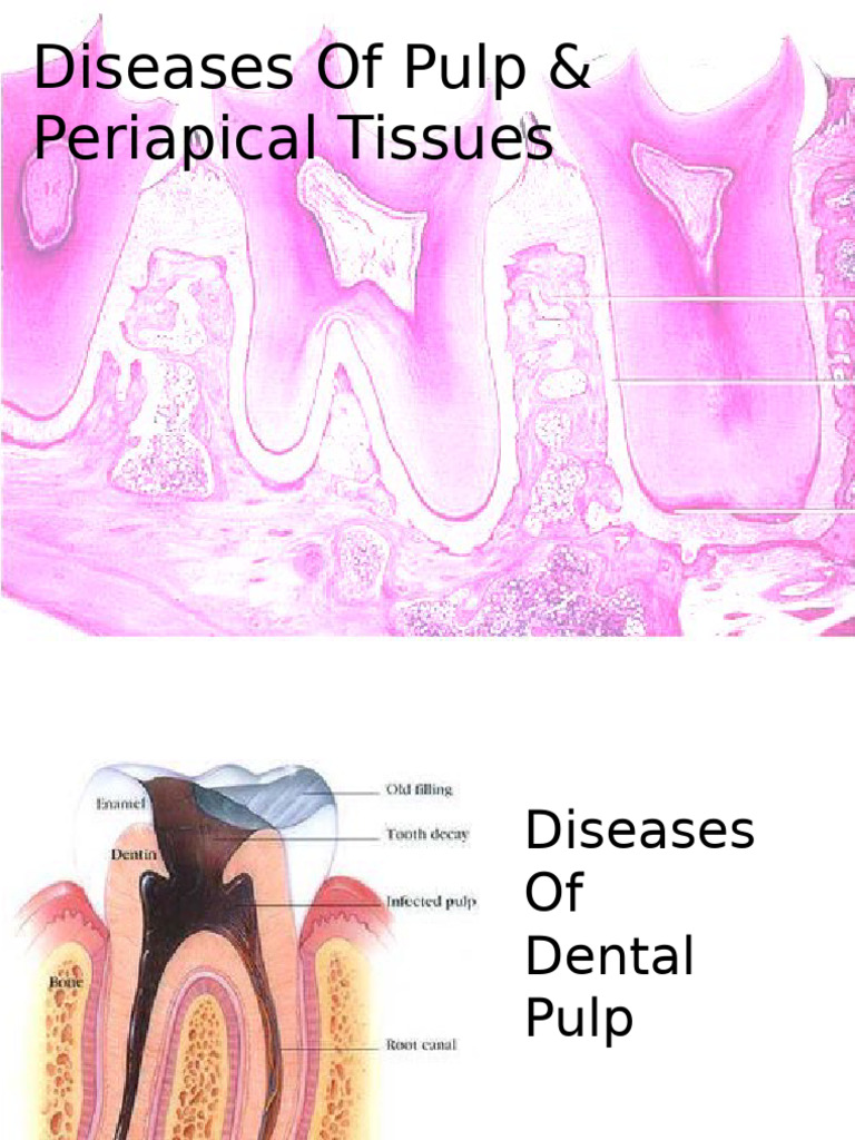 Pulp and Periapical Tissue Diseases | PDF | Inflammation | Human Tooth