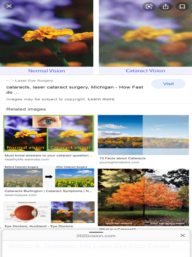 Cataract Vision - Google Search | PDF