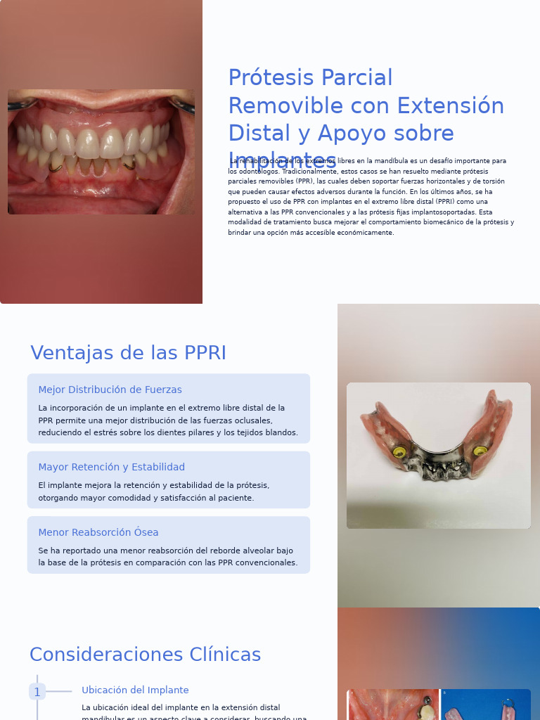 Protesis Parcial Removible Con Extension Distal y Apoyo Sobre Implantes ...