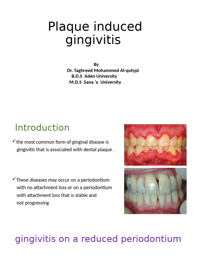 Plaque Induced Gingivitis | PDF | Inflammation | Medical Specialties