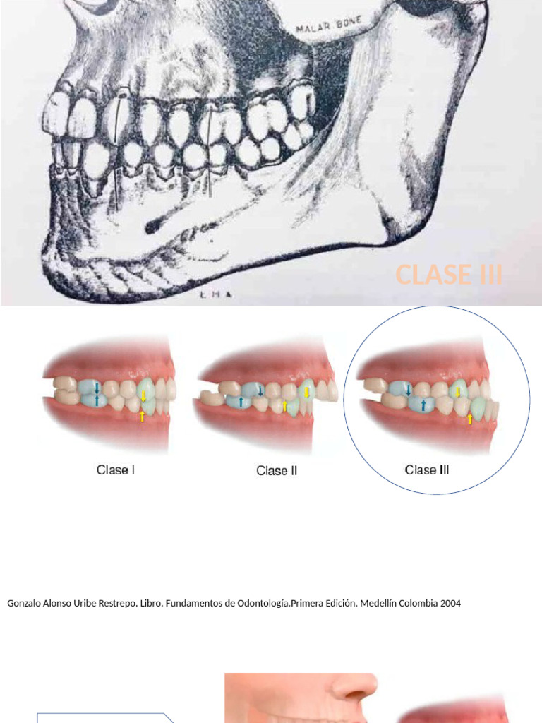Clase Iii | PDF | Ortodoncia | Odontología