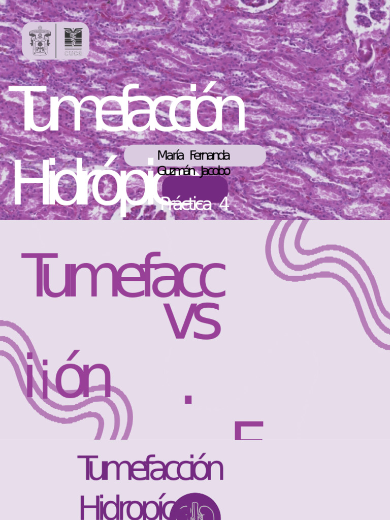 Tumefacción Hidrópica | PDF