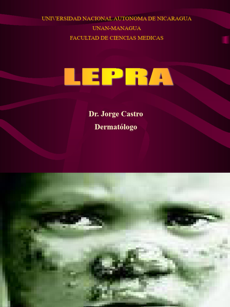 02 - Lepra.ppt | PDF | Lepra | Mycobacterium