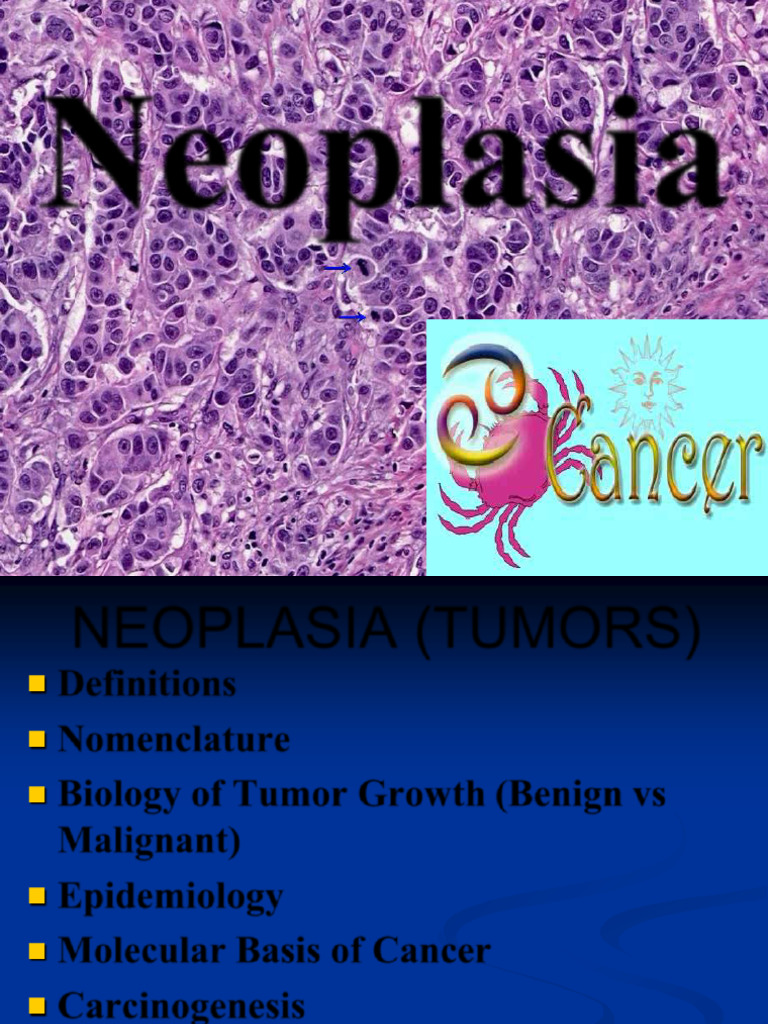 Understanding Neoplasia and Tumors | PDF | Neoplasms | Metastasis