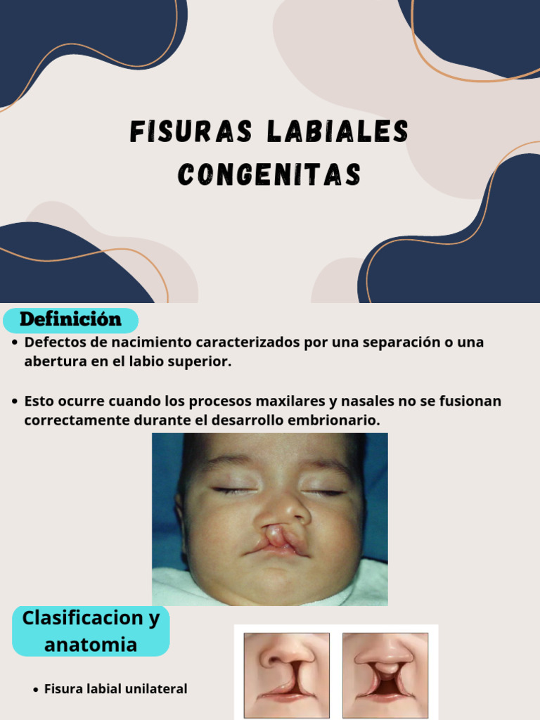 Fisuras Labiales Congénitas: Causas y Tratamiento | PDF | Odontología ...