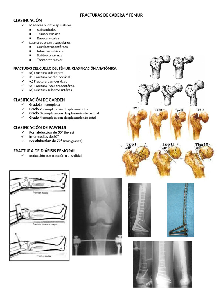 Clasificación y Tratamiento de Fracturas de Cadera y Fémur | PDF