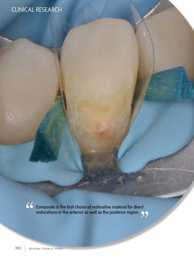 Clinical Performance of Direct and Indirect Adhesive Restorations | PDF ...
