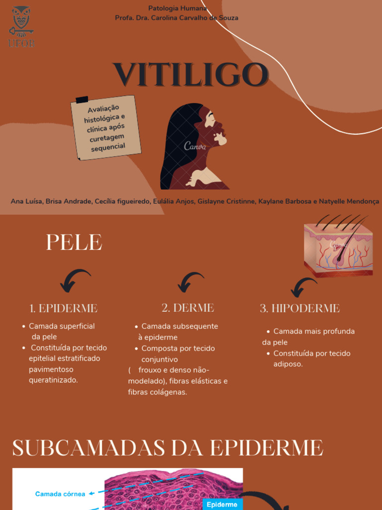 vitiligo | PDF | Pele | Epiderme