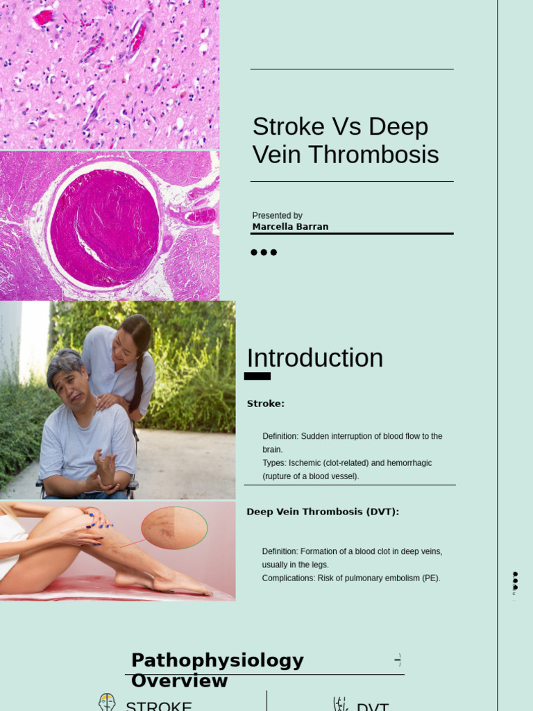 Stroke vs Deep Vein Thrombosis | PDF | Thrombosis | Thrombus