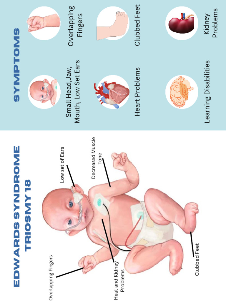 Edwards Syndrome Triosmy 18 | PDF