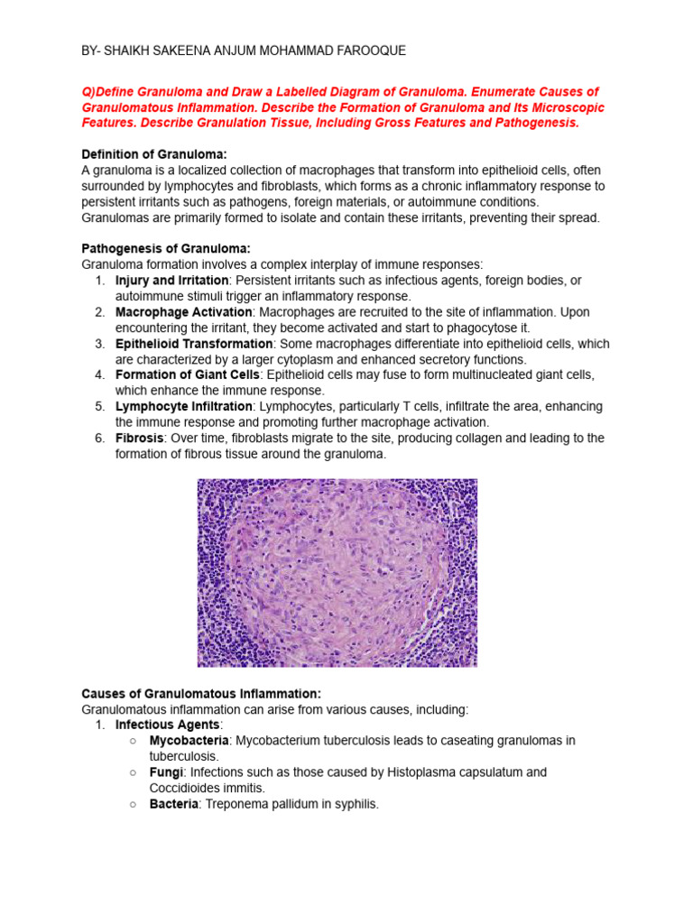 Q)Define Granuloma and Draw a Labelled Diagram of Granuloma. Enumerate ...