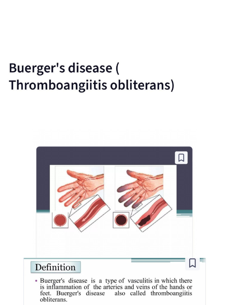 Thromboangiitis Obliterans | PDF