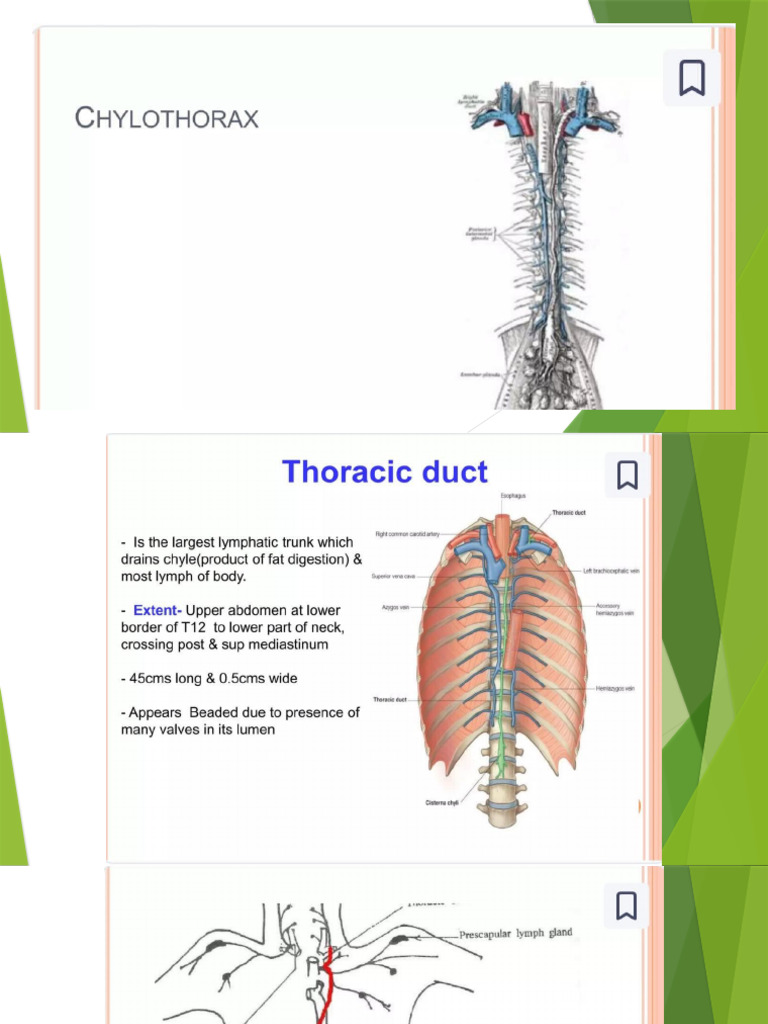 Chylothorax | PDF