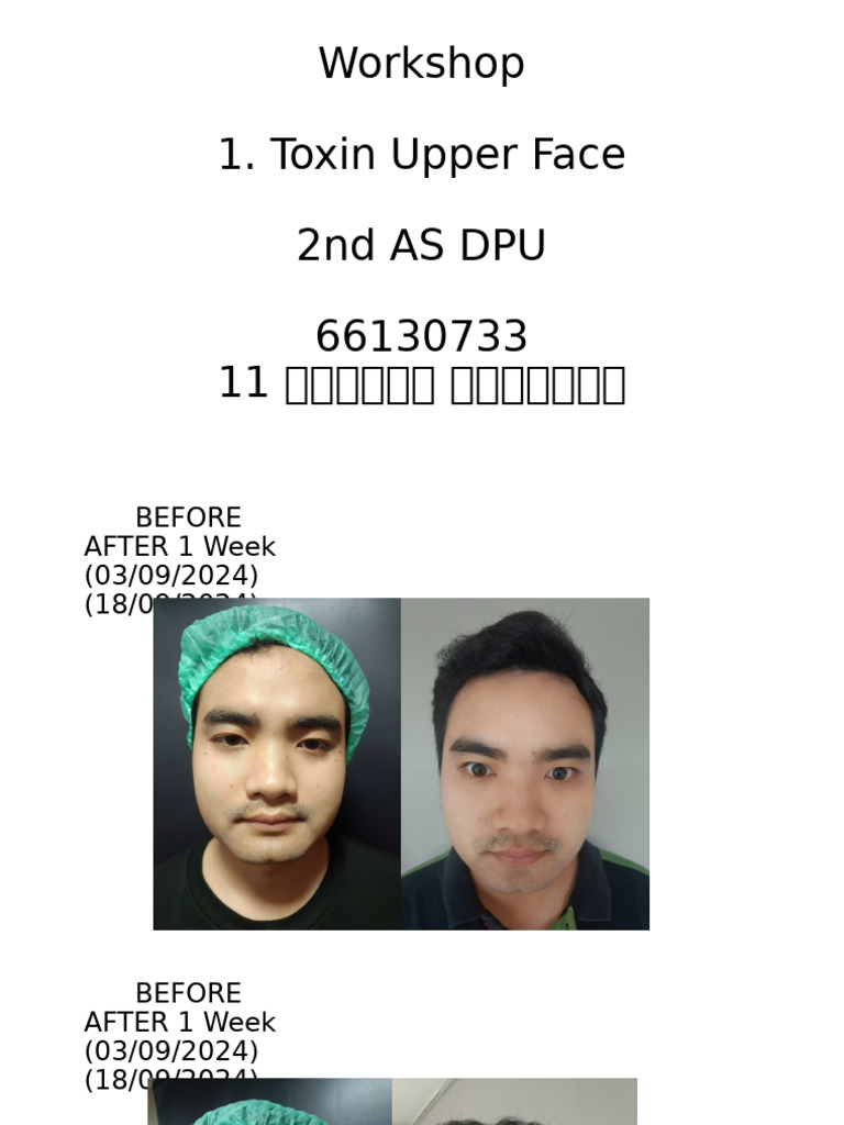 Toxin Upper Face Workshop Results | PDF