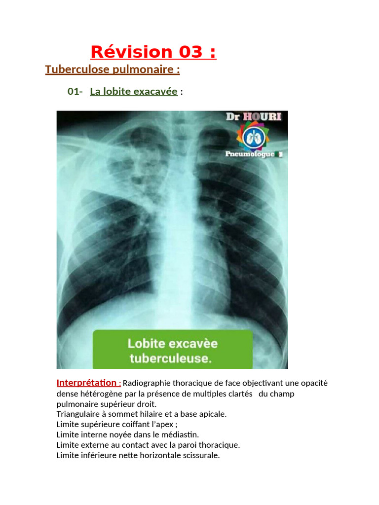 Révision 03 | PDF | Tuberculose | Maladies et troubles humains