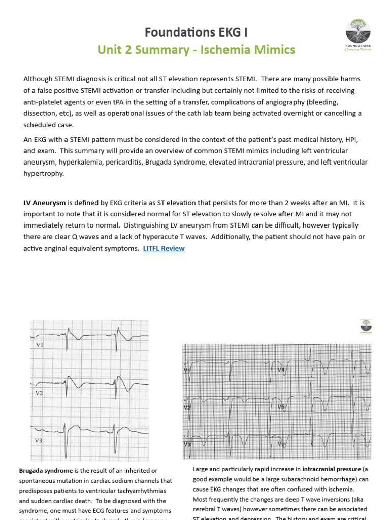 Common STEMI Mimics in EKG Analysis | PDF | Electrocardiography ...