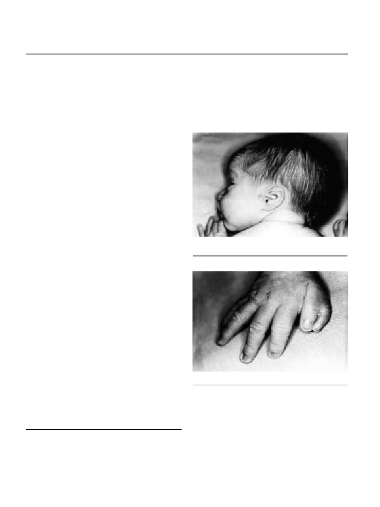 Síndrome de Townes-Brocks: Caso Español | PDF | Especialidades Medicas ...