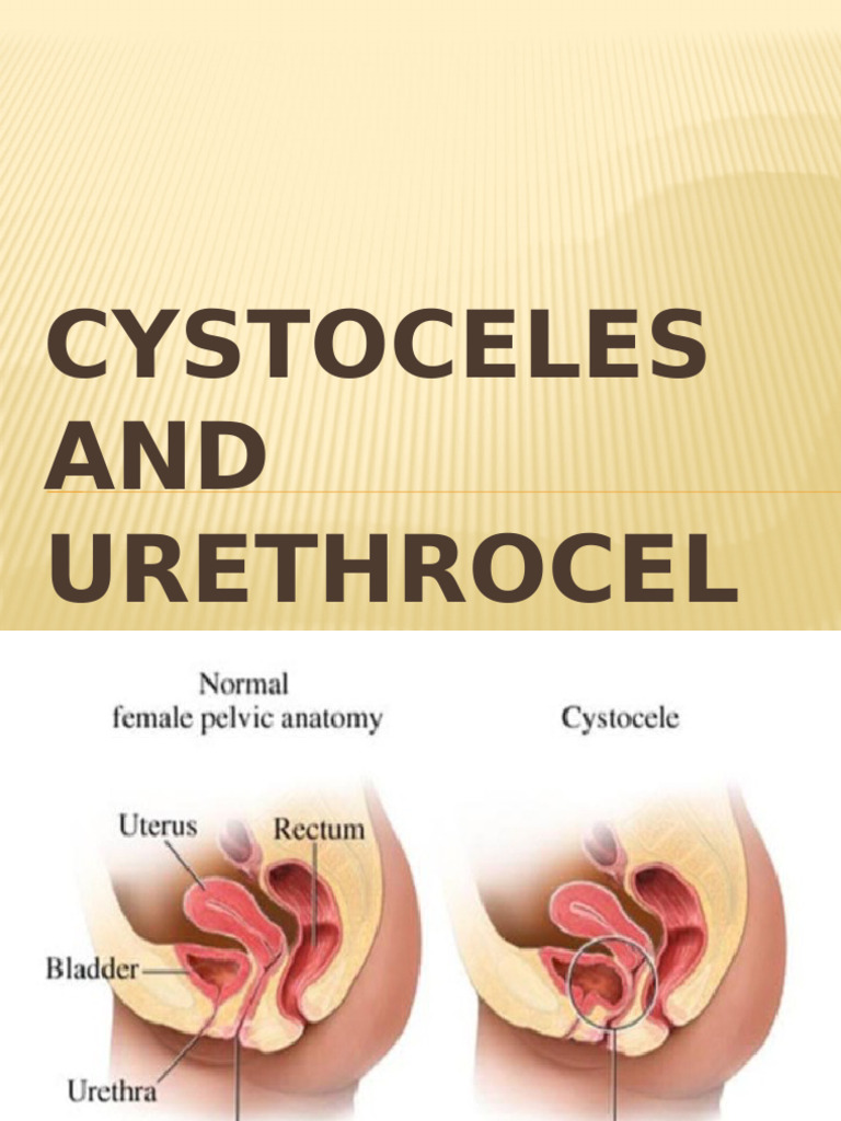Cystocele and Urethrocele Guide | PDF