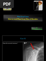 Jurnal 1 Modified Axillary Radiograph of The Shoulder A New Position ...