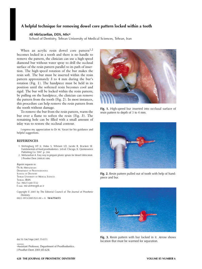 A helpful technique for removing dowel core pattern | PDF | Dentistry ...
