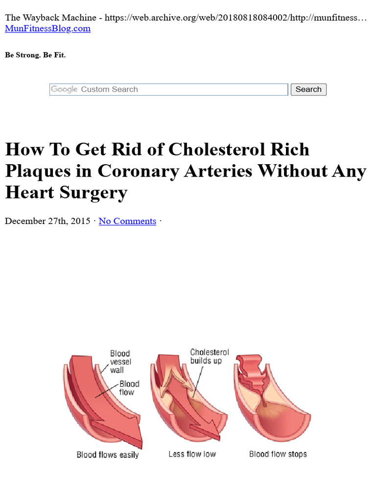 How To Get Rid of Cholesterol Rich Plaques in Coronary Arteries Without ...