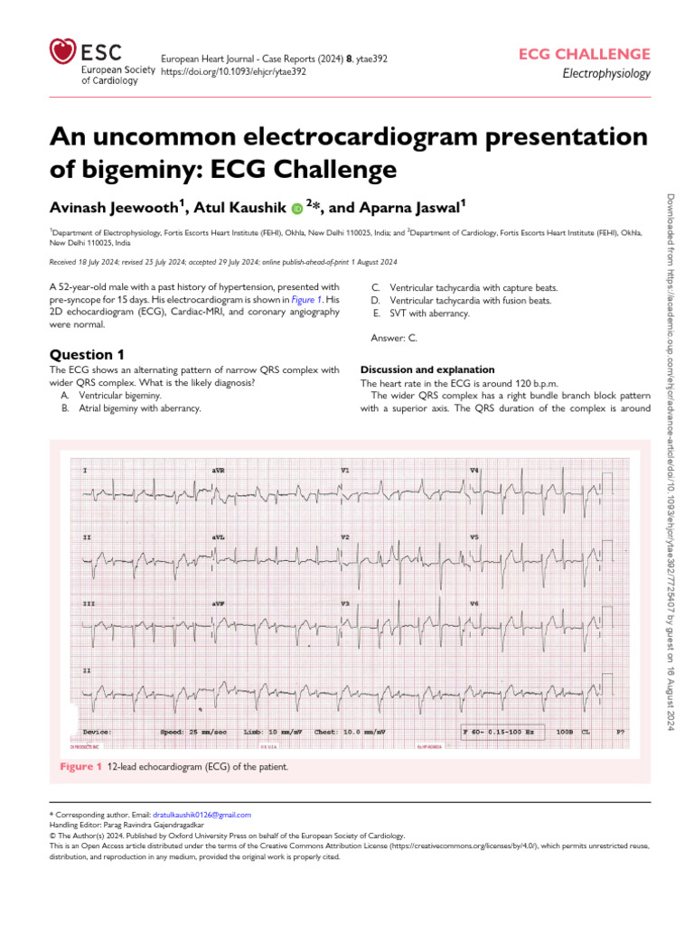 2024-Uncommon ECG Presentation of Bigeminy | PDF | Electrocardiography | Cardiology