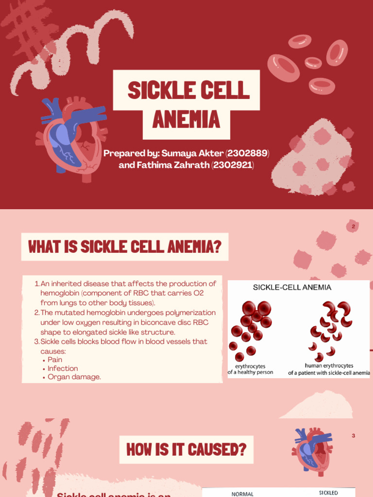 Understanding Sickle Cell Anemia | PDF | Anemia | Hemoglobin