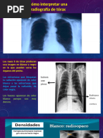Proyecciones Rx de Tórax: PA y AP | PDF | Tórax (anatomía humana ...