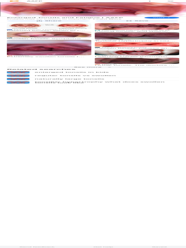 Large Normal Tonsils - Google Search | PDF